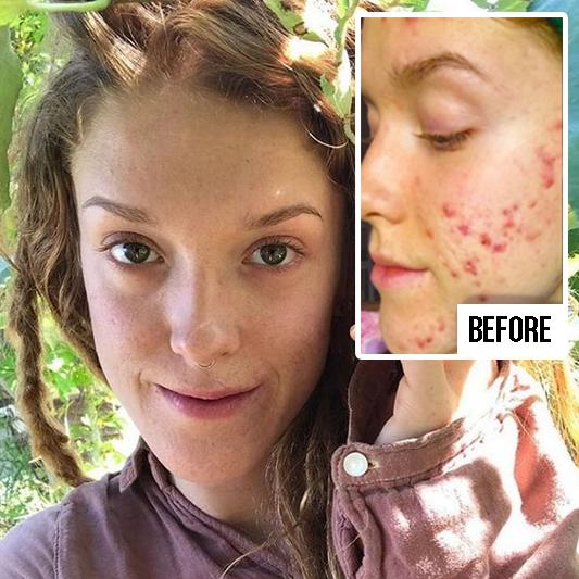 Clear Skin Transformation Program | Le Bijou Holistic Spa | Oceanside, CA